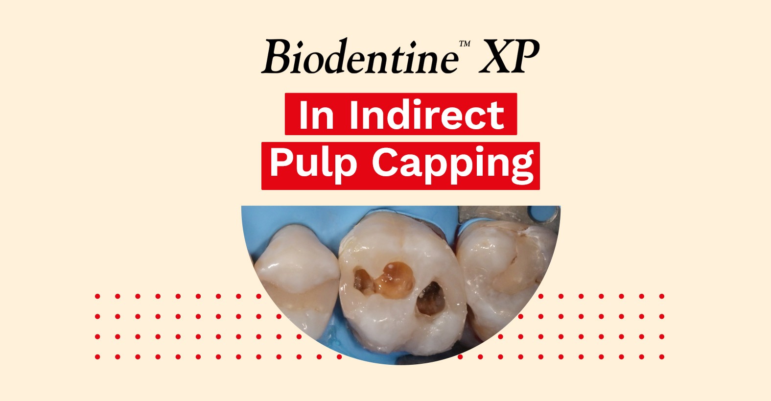 Indirect Pulp Capping - Bio-Bulk fill method with Biodentine - Case ...